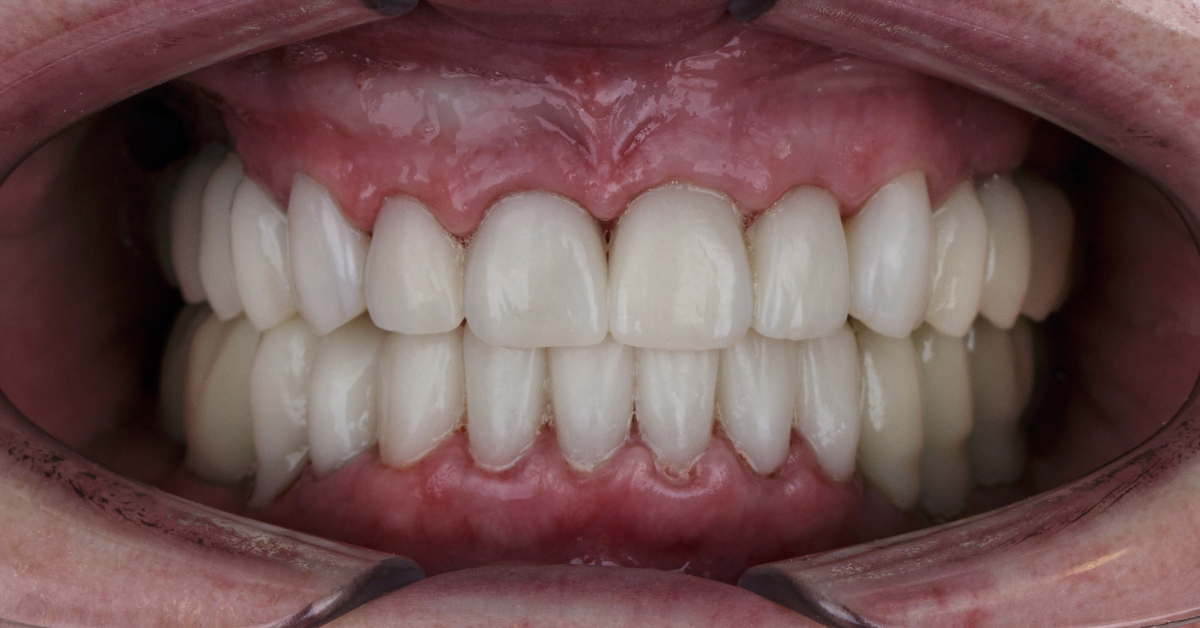 Composite Bonding - Excel Dental Care